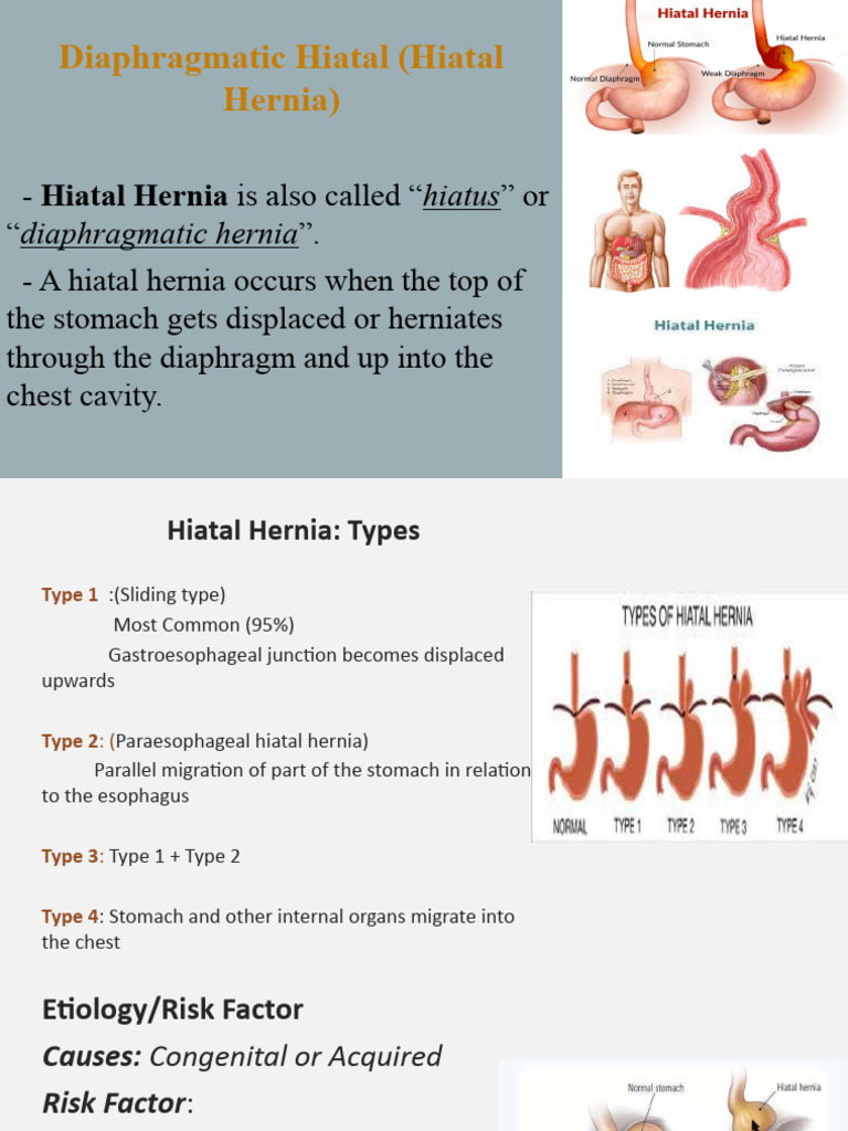 Diaphragmatic Hernia Hiatal Hernia Final Pdf Clinical Medicine
