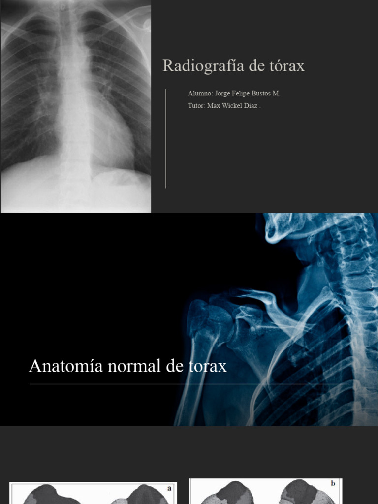 rx torax | PDF