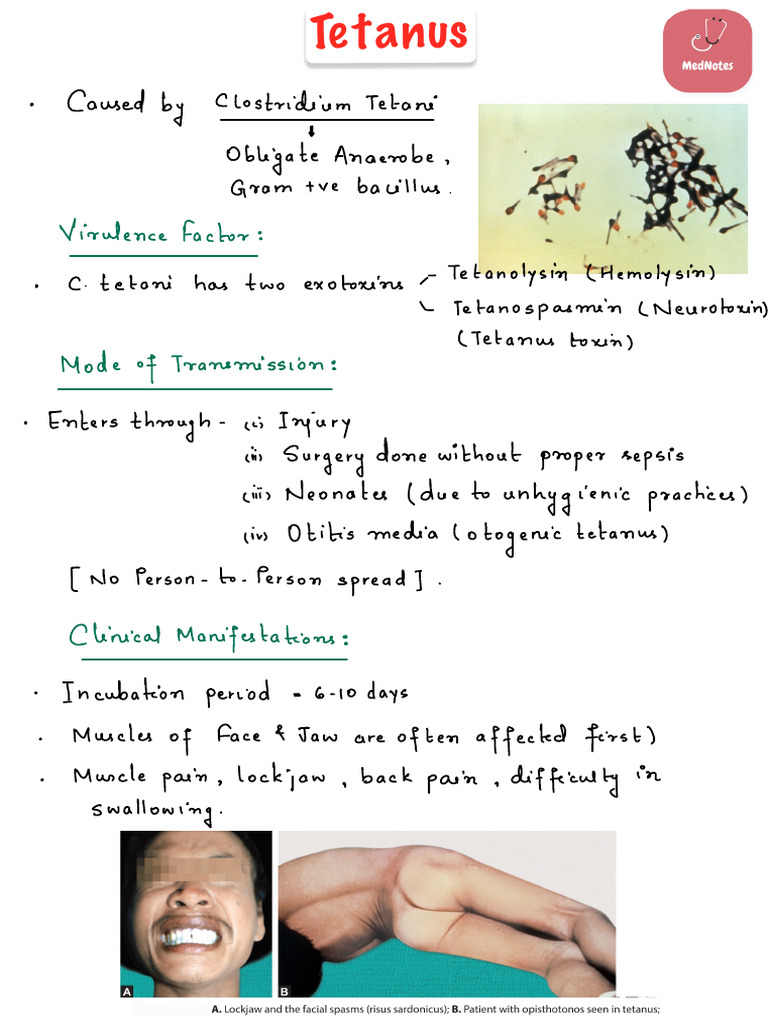 Tetanus | PDF | Clinical Medicine | Medical Specialties
