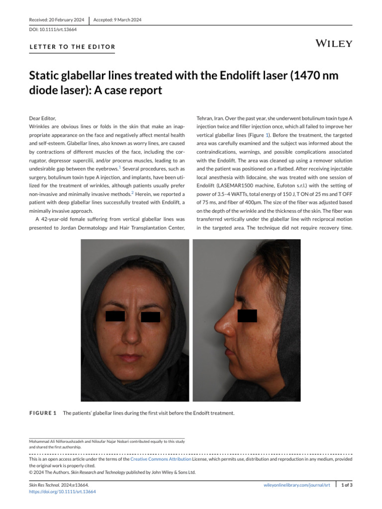 Static Glabellar Lines Treated With The Endolift Laser (1470 NM Diode ... Static Glabellar Lines Treated With The Endolift Laser (1470 NM Diode ...