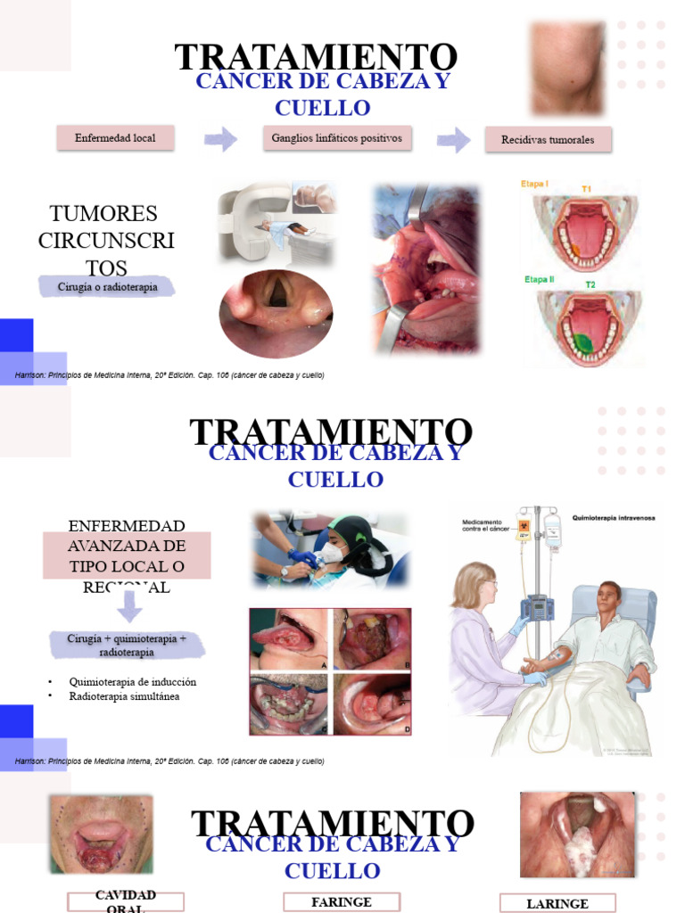 Cancer de Cabeza Cuello 4 | PDF | Cáncer | Terapia