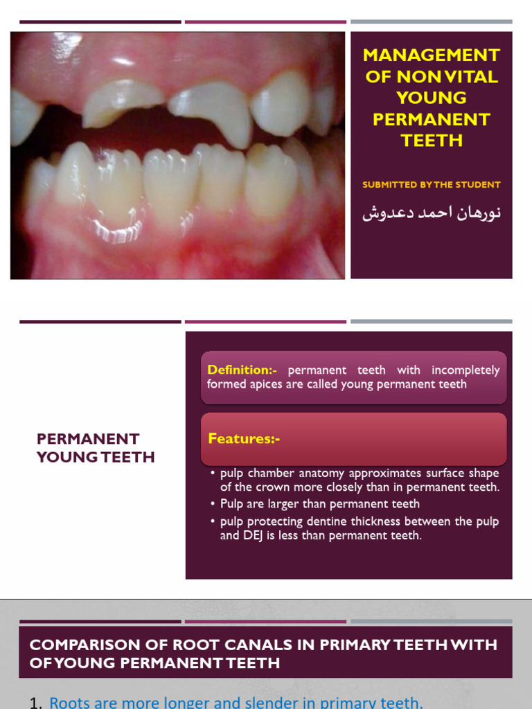 Management of Non Vital Young Permanent Teeth | PDF | Human Tooth | Dentin