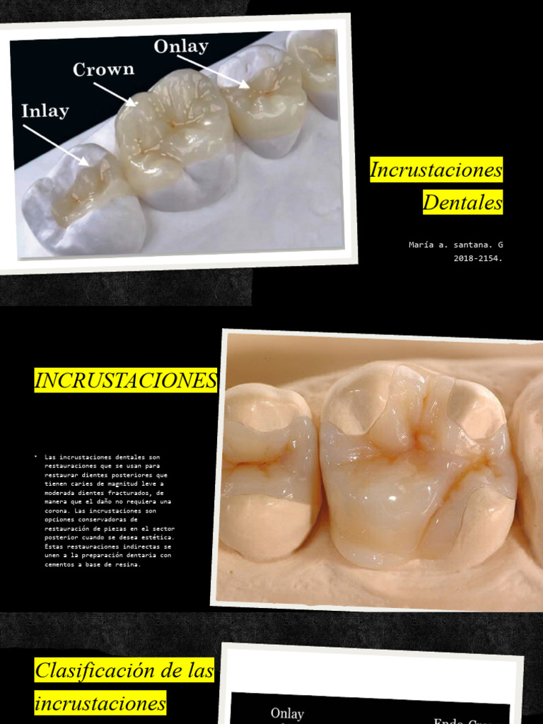 incrustaciones dentales | PDF | Diente | Odontología