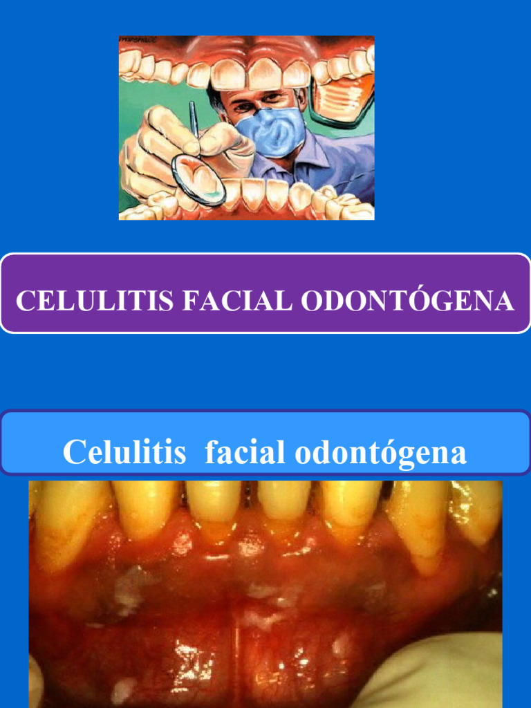 Celulitis Facial Odontógena: Diagnóstico y Tratamiento | PDF ...