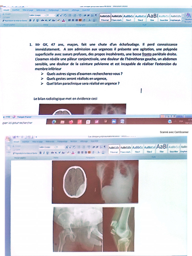 Polytraumatisme | PDF