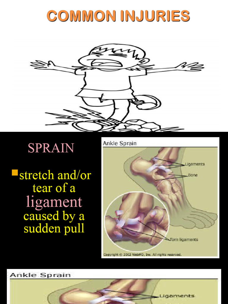 Understanding Sprains, Strains, and Fractures | PDF | Medical ...