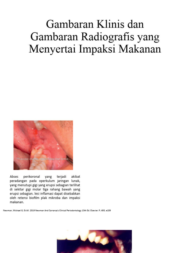 Gambaran Klinis Dan Gambaran Radiografis Yang Menyertai Impaksi | PDF