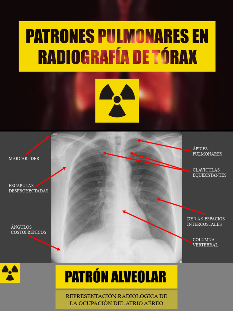 Patrones Torax en RX | PDF | Neumonía | Pulmón