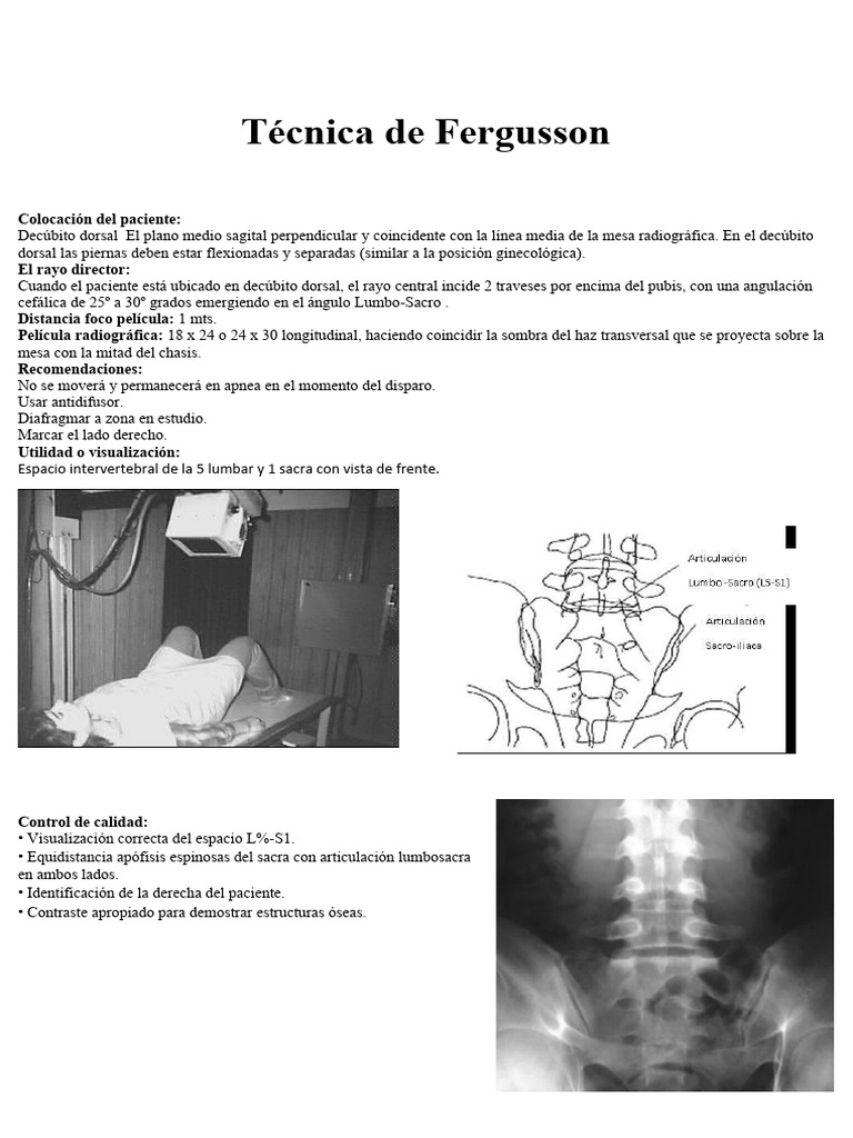 Técnica de Fergusson | PDF