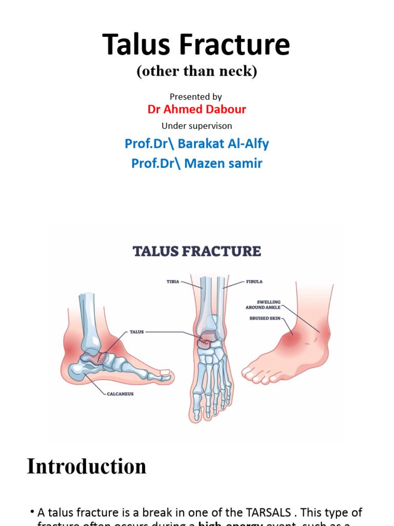 Talus Fracture: Diagnosis & Treatment | PDF | Ankle | Human Anatomy