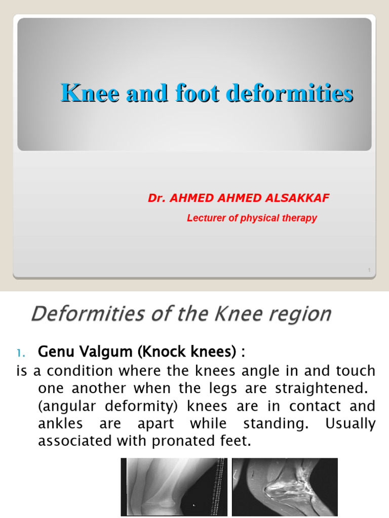 Knee and Foot Deformities ٠٥١٧١٧ | PDF | Knee | Foot