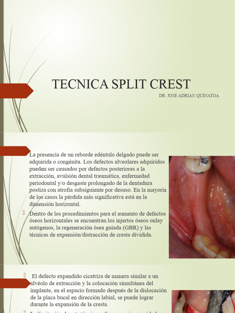 Tecnica Split Crest | PDF | Hueso | Piezoelectricidad