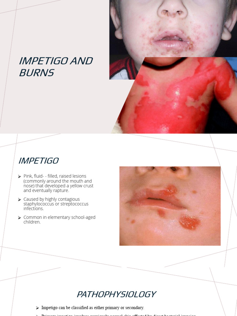2 3. IMPETIGO and Burns 1 1 | PDF | Burn | Medical Specialties