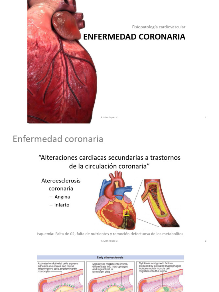 Fisiopatología y Manejo del IAM | PDF | Circulación coronaria | Corazón