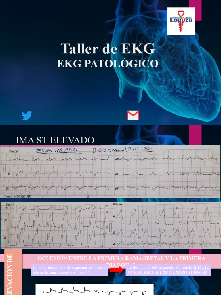 Taller de Ekg Patológico-2024 | PDF