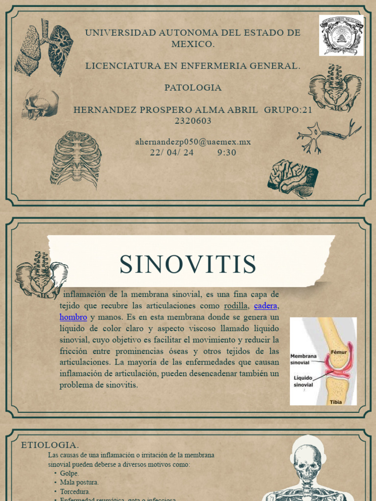 Sinovitis | PDF | Artritis Reumatoide | Medicina CLINICA