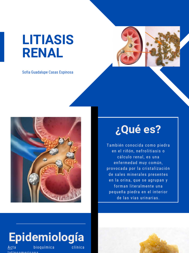 Litiasis Renal | PDF | Especialidades Medicas