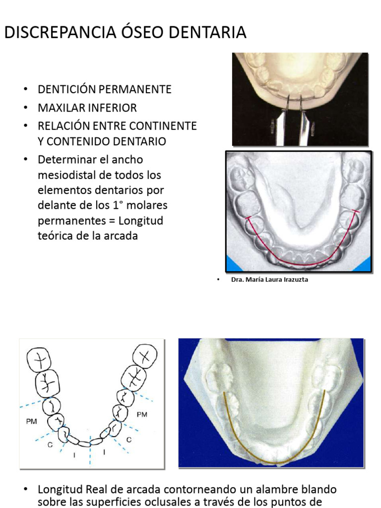 Discrepancia Óseo Dentaria y Análisis de Bolton | PDF | Odontología ...