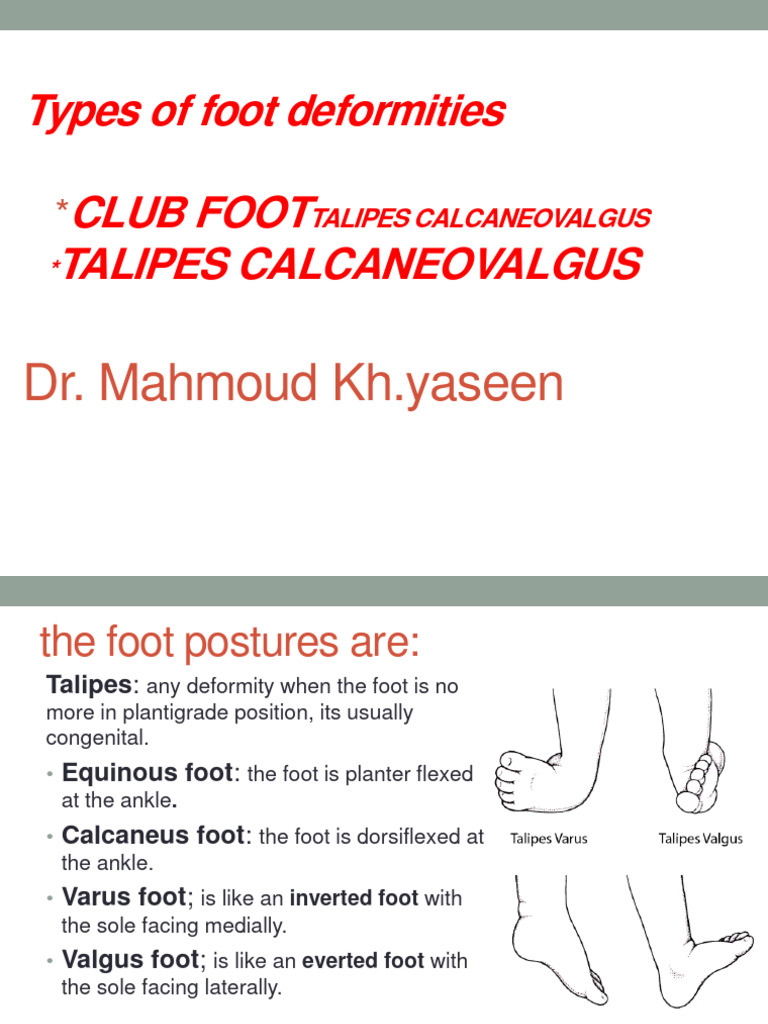 Clubfoot | PDF | Foot | Ankle