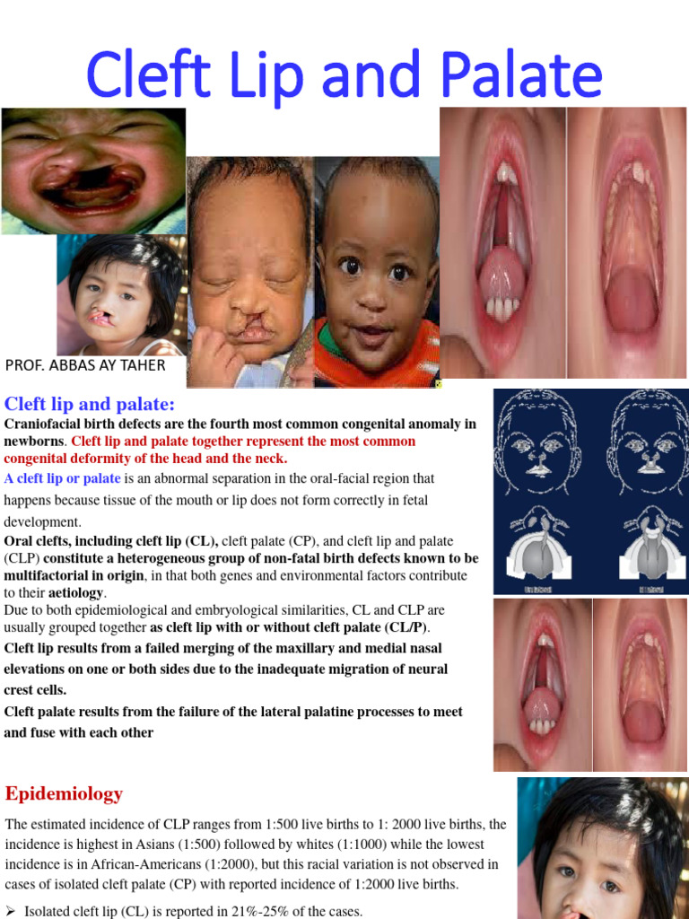 Cleft Lip and Palate Overview | PDF | Bone | Medical Specialties