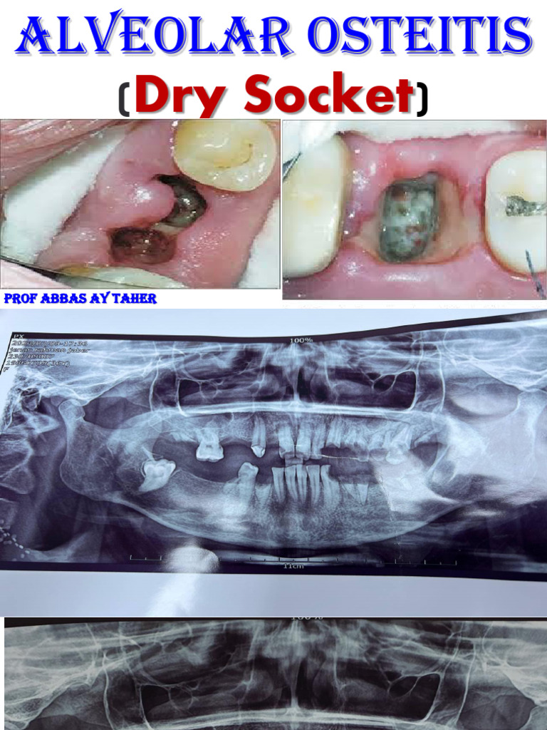 Alveolar Osteitis-DRY SOCKET | PDF | Wound Healing | Medical Specialties