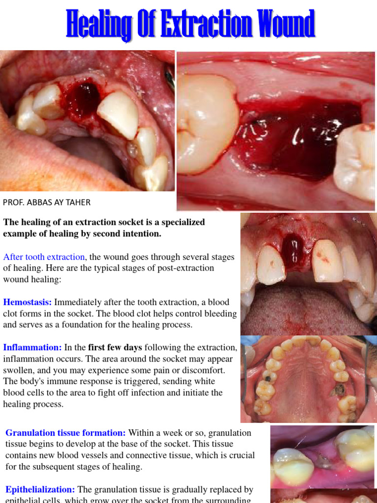 Healing of Extraction Wound | PDF | Wound Healing | Bone