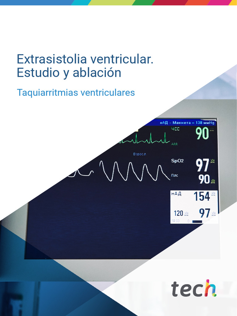 Ablación de Extrasistolia Ventricular | PDF | Sistema cardiovascular ...