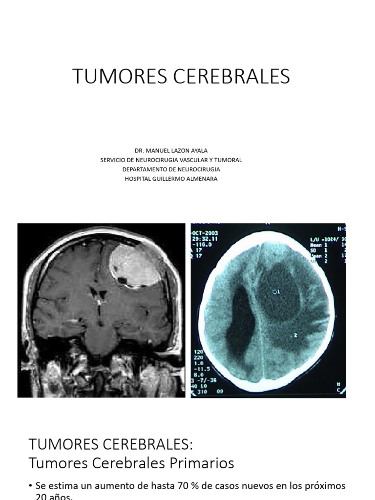 TUMORES CEREBRALES[1] | PDF | Tumor cerebral | Cáncer