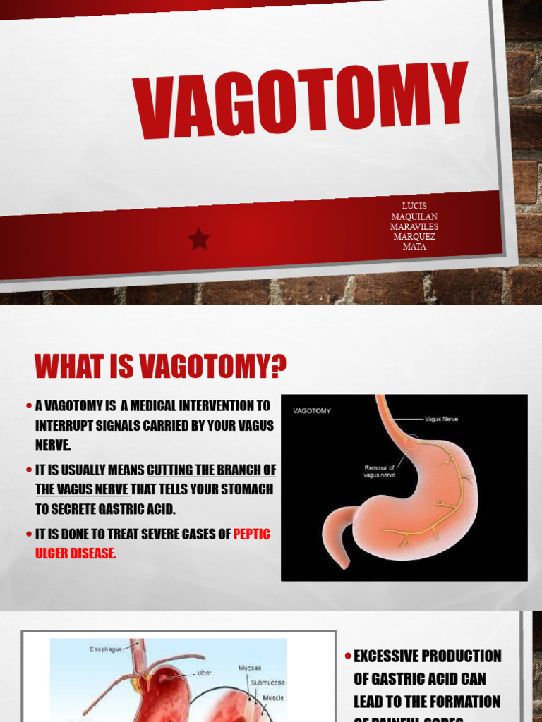 VAGOTOMY | PDF | Stomach | Gastrointestinal Tract