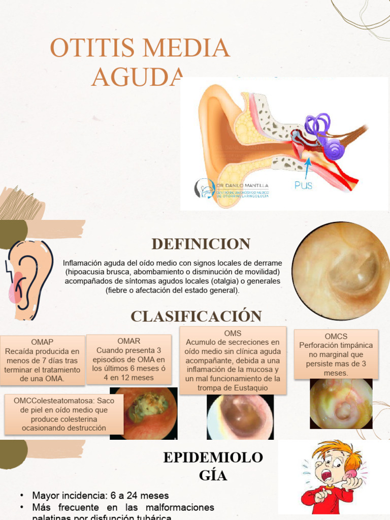 Guía sobre Otitis Media Aguda: Definición y Clasificación | PDF