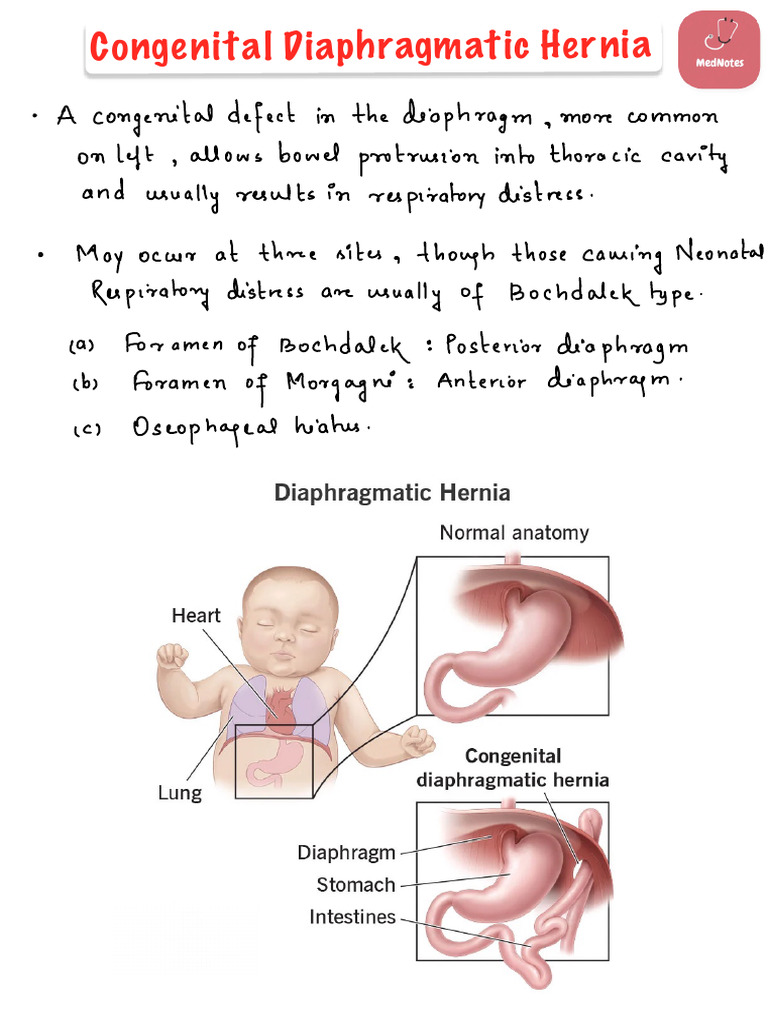 Congenital Diaphragmatic Hernia Radiology | PDF