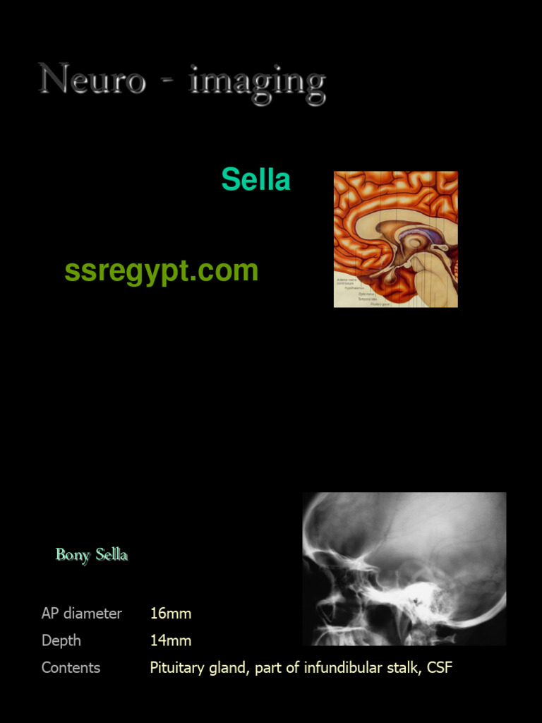 Sella | PDF | Pituitary Gland | Anatomy