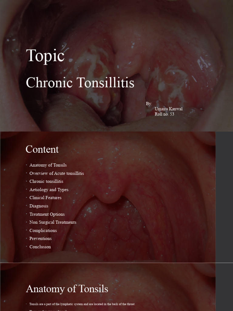 Chronic Tonsillitis Presentation | PDF | Epidemiology | Causes Of Death