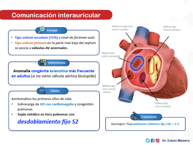 Comunicación Interauricular: Guía Clínica | PDF