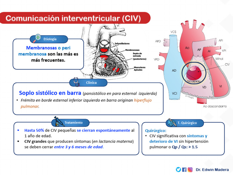 Comunicación Interventricular (CIV) | PDF