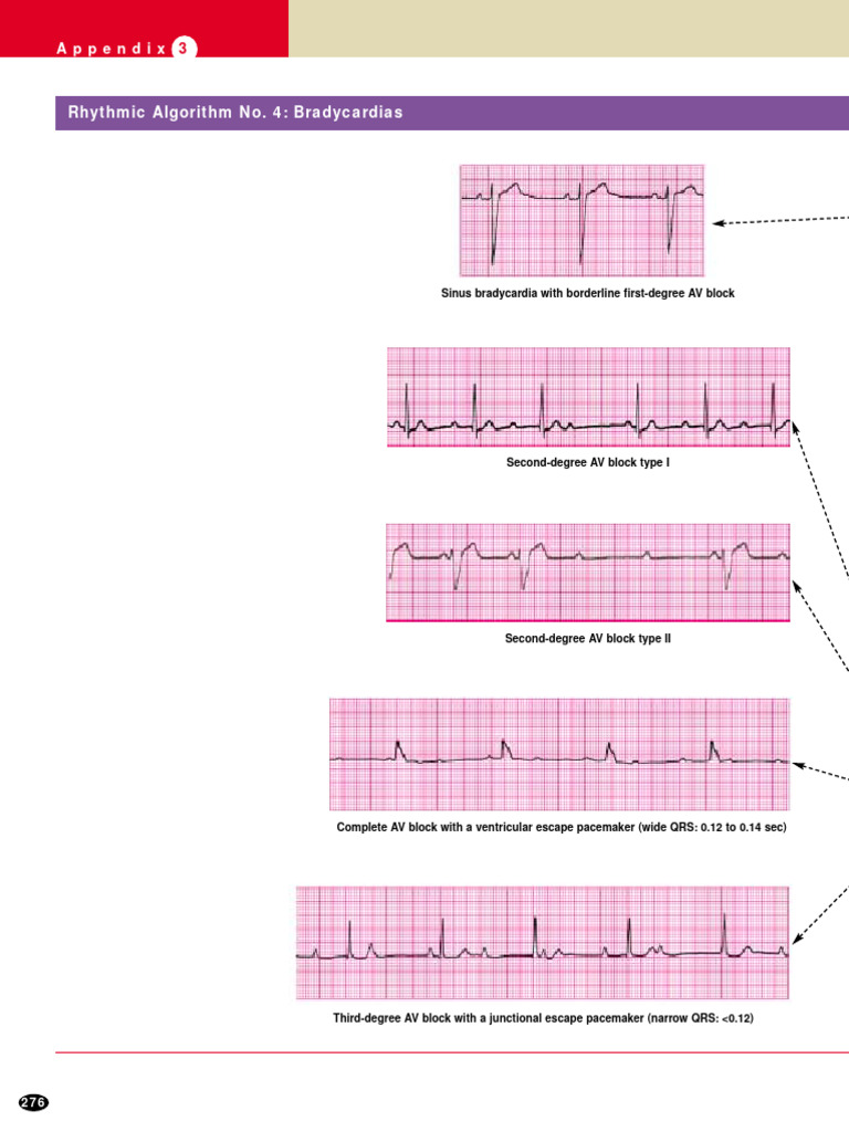 ECG - Rhythms - For - ACLS - 201309101532569240 Pages 276, 277 | PDF ...
