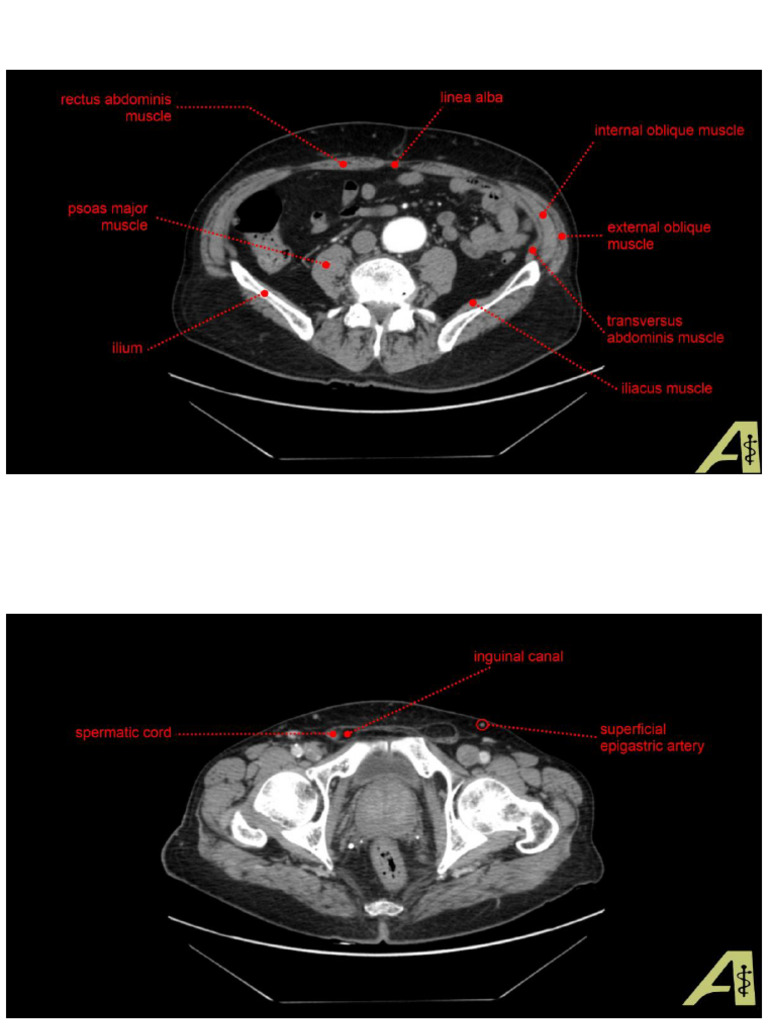 Abdomen CT | PDF