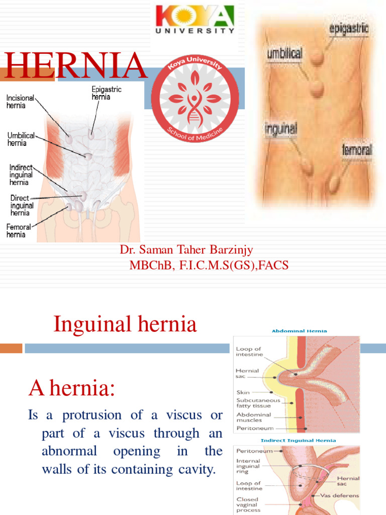 Hernias | PDF