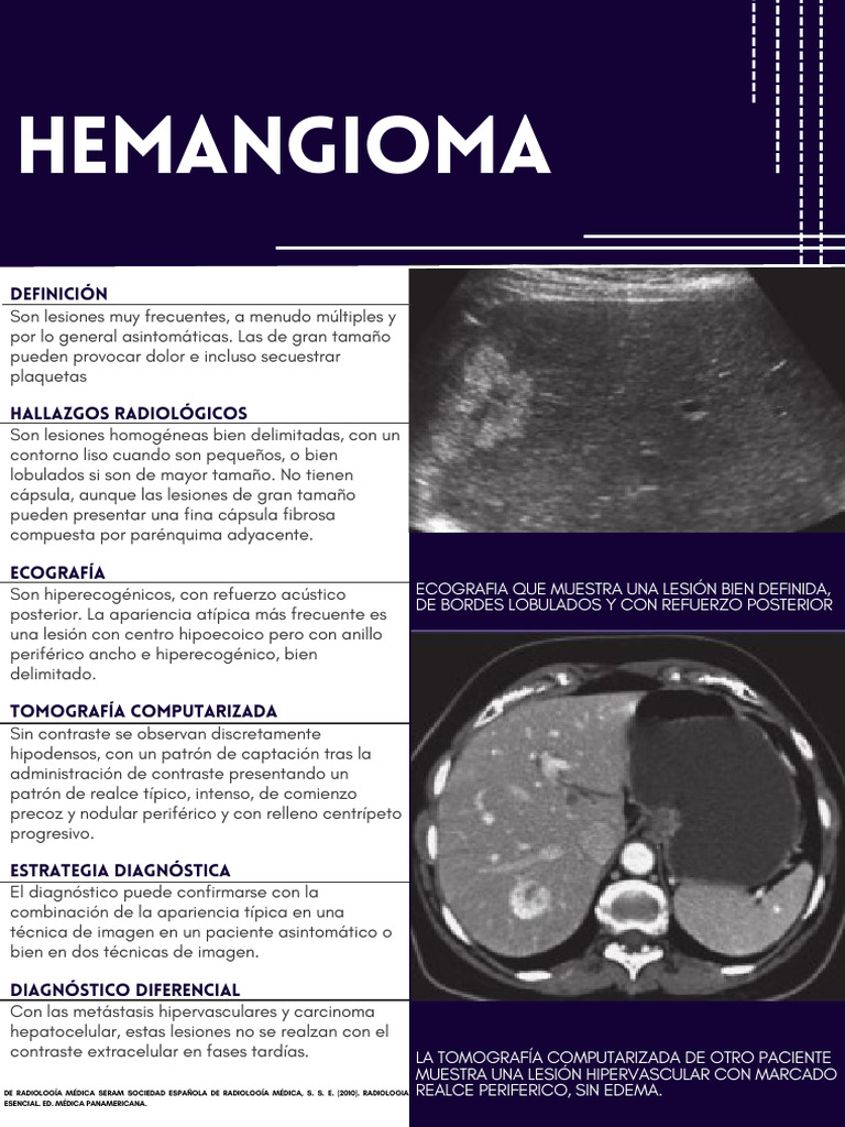 Hemangioma - Luis Obregón - Abril | PDF | Salud y bienestar