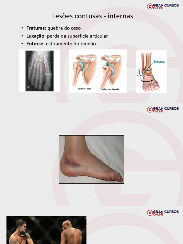 Aula 3 - TRAUMATOLOGIA – LESÕES CONTUSAS II slides | PDF