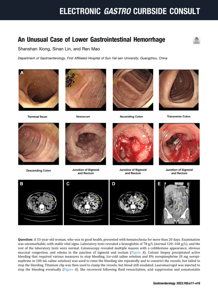 Cirsoid Aneurysm in GI Hemorrhage | PDF | Large Intestine | Angiography