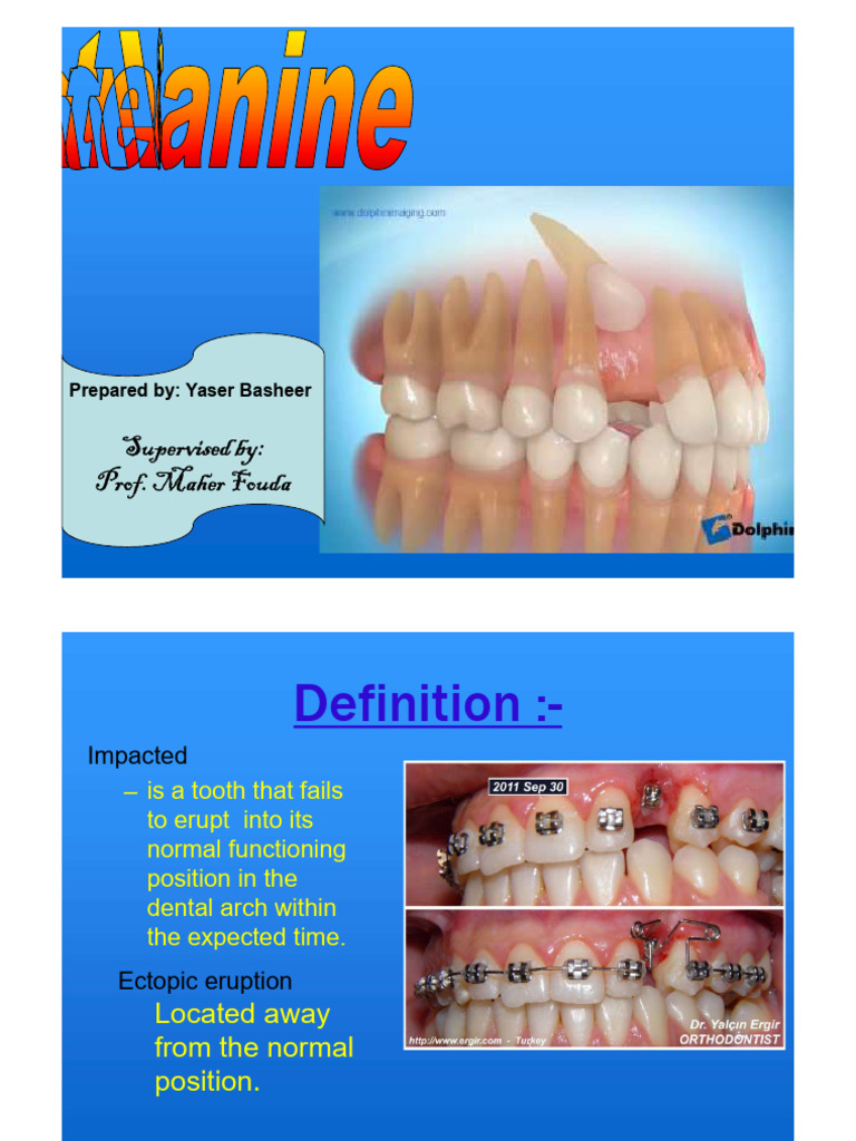 Impacted Canine | PDF | Orthodontics | Dental Anatomy