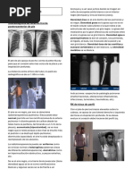 Proyecciones Rx de Tórax: PA y AP | PDF | Tórax (anatomía humana ...