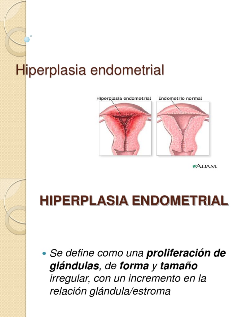 Hiperplasia Endom | PDF | Hormona luteinizante | Ciclo menstrual