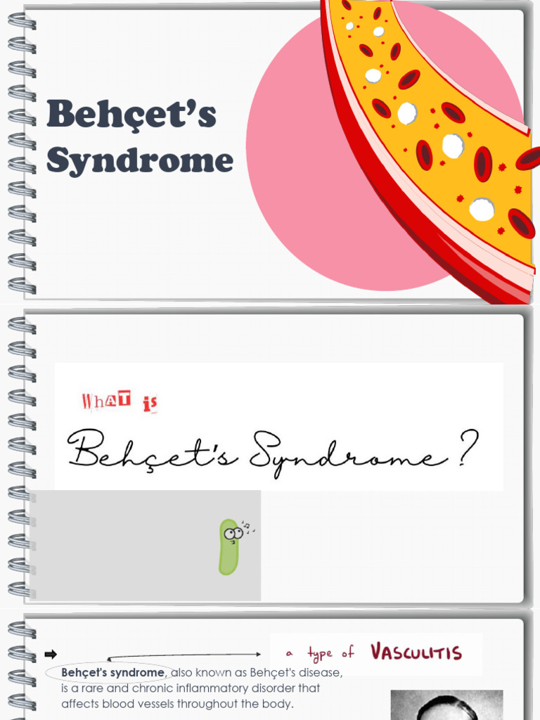 BEHCET'S Syndrome Wardclass PDF Mode | PDF | Inflammation | Immune System