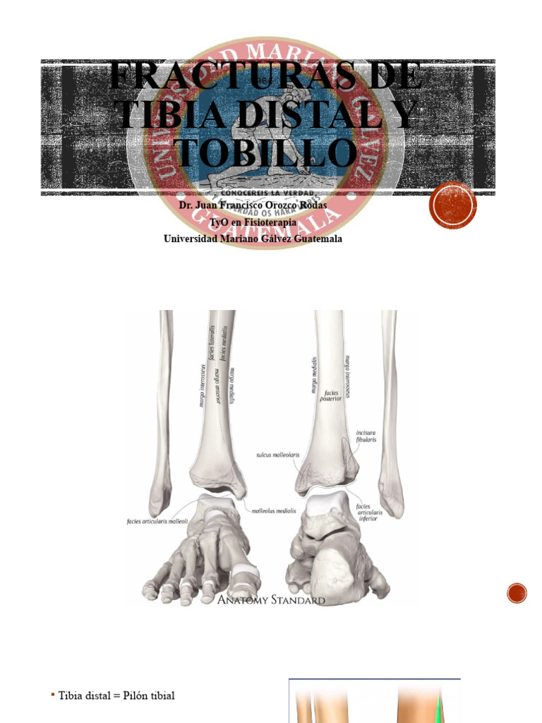 Fracturas de Tibia Distal y Tobillo | PDF | Tobillo | Medicina CLINICA