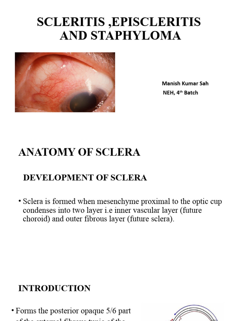 Scleritis and Episcleritis Overview | PDF | Causes Of Death | Human Eye