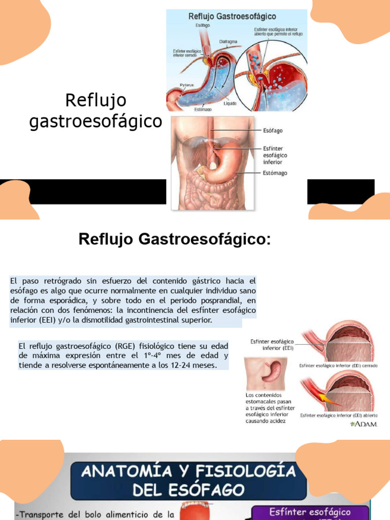 Reflujo Gastroesofágico en Pediatría | PDF | La enfermedad por reflujo ...