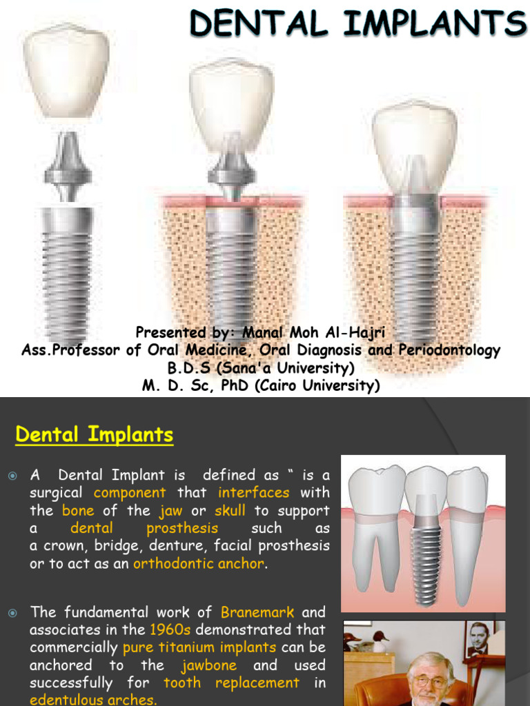 Implant 2 | PDF | Dental Implant | Mouth