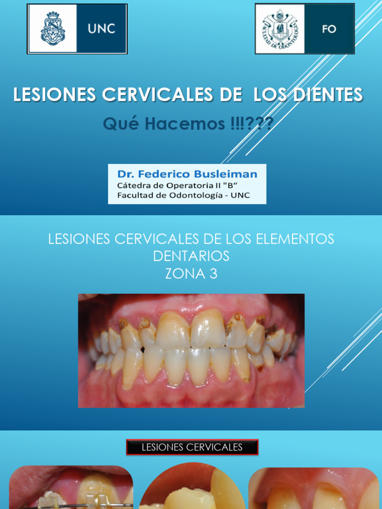 Lesiones Cervicales de Los Dientes Tratamiento Ope 2b 2024 | PDF ...
